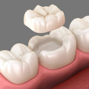 Inlays vs. Crowns Explained: Tooth Restoration 101 — Elizabeth L. Wakim ...