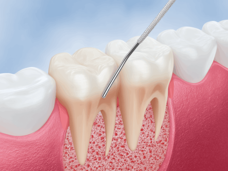 What Causes Receding Gums and Why It’s Worth Paying Attention To ...