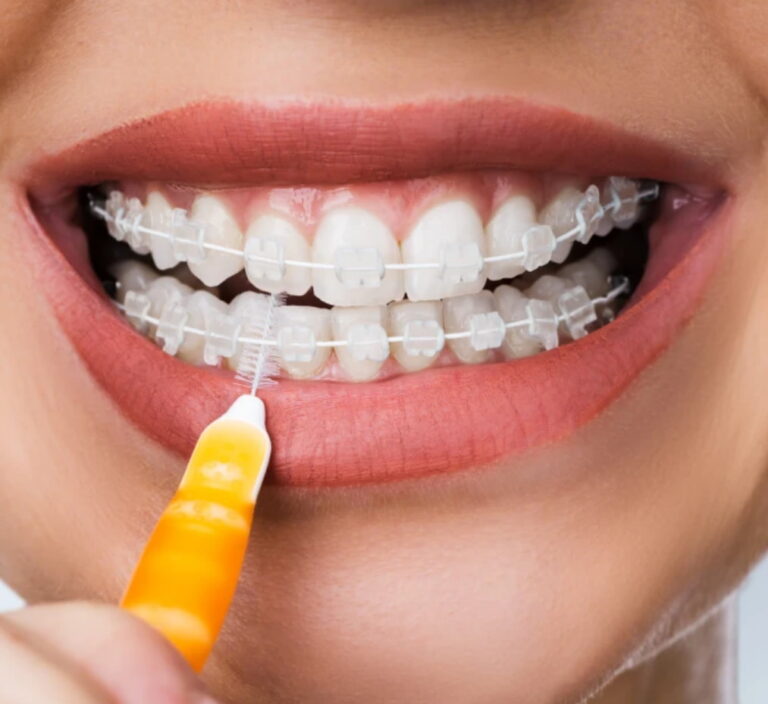 3D Printed Braces: Do They Work and Are They Worth it? — Elizabeth L ...