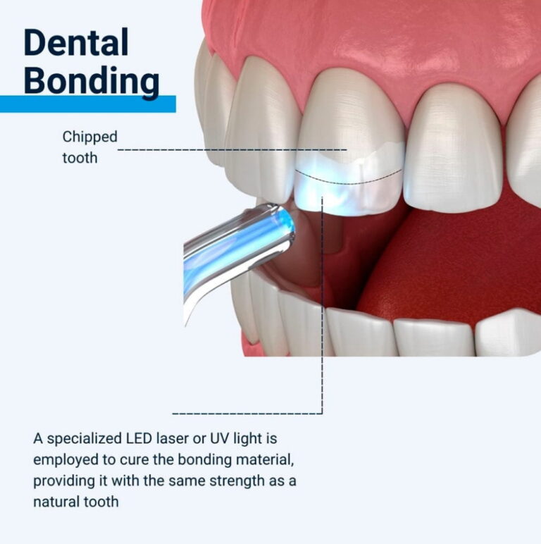 Teeth Filing: Everything You Need to Know About When It Is (And Isn’t ...