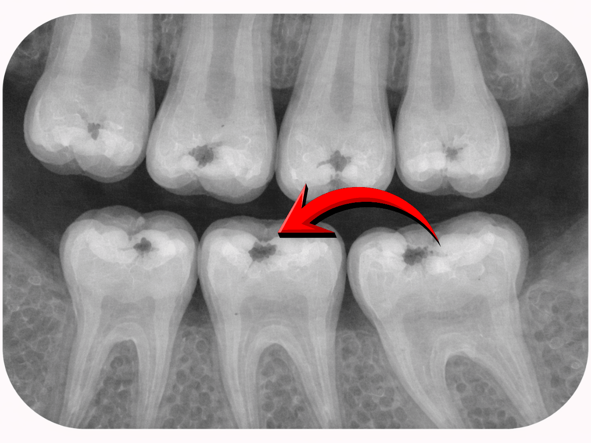 Dental Cavity Images: Identifying Cavities Before They Worsen ...
