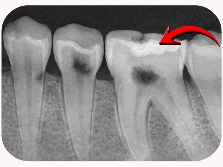 Dental Cavity Images: Identifying Cavities Before They Worsen ...