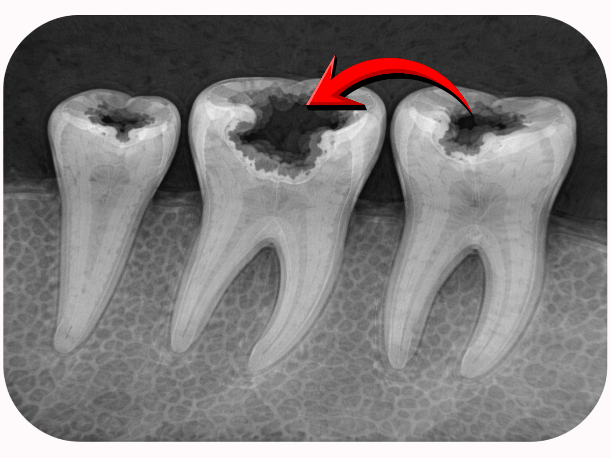 Dental Cavity Images: Identifying Cavities Before They Worsen ...